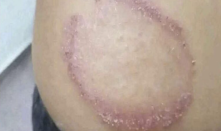 Understanding Skin Fungal Infections and Ringworm: Causes, Treatment ...